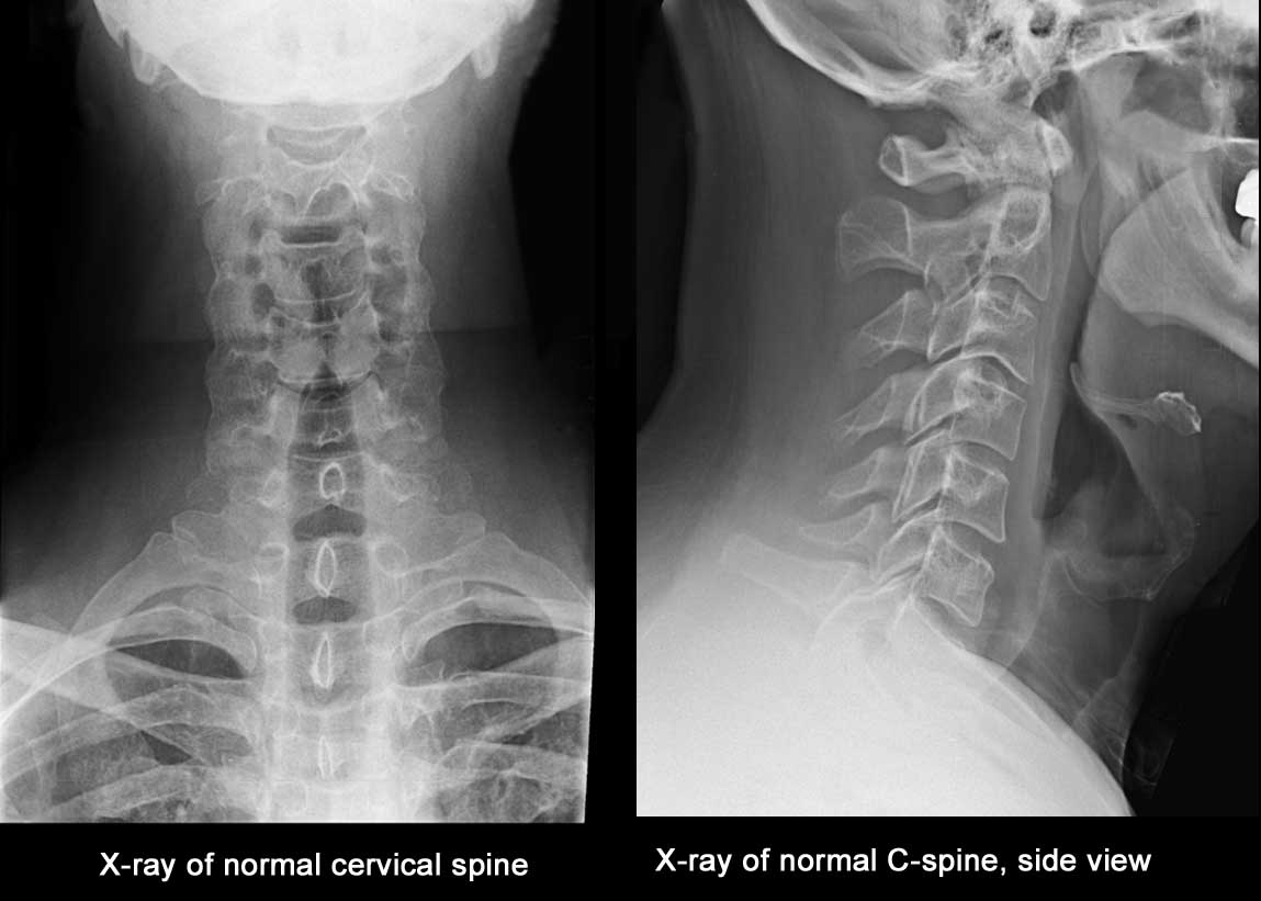 479337_NORMAL_cerv_X-ray – Mountain View Chiropractic